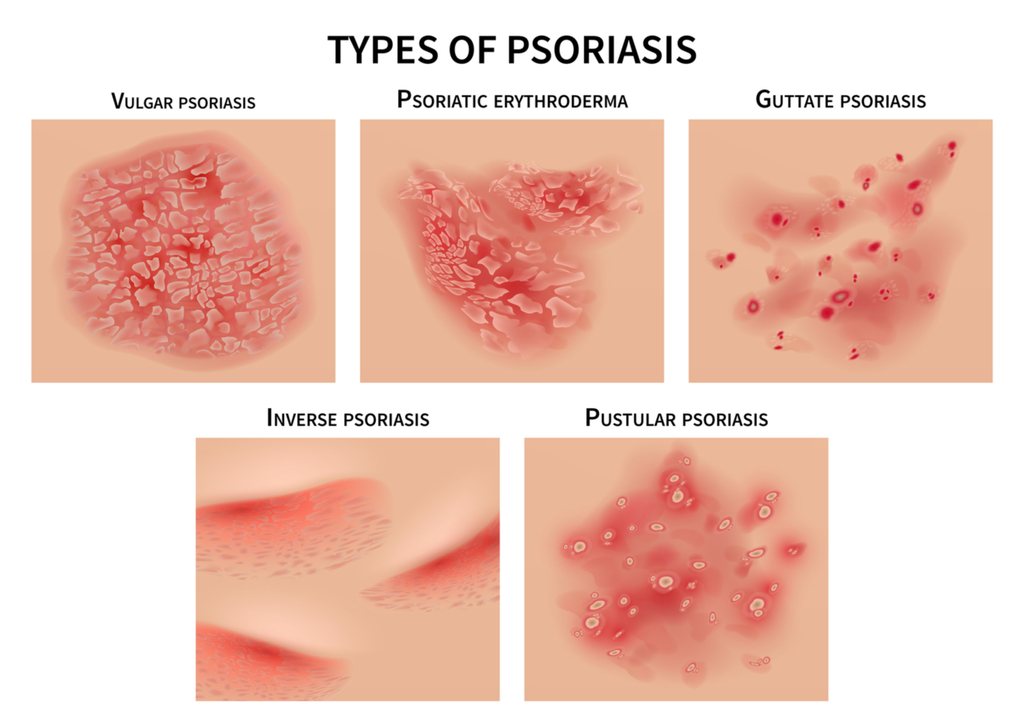 August Is Psoriasis Awareness Month Suntree Internal Medicine